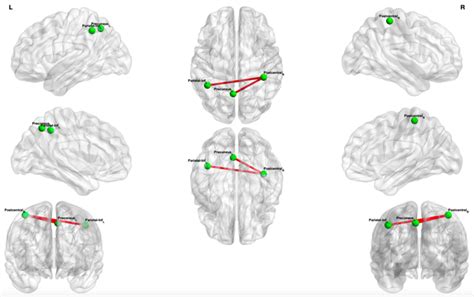 Whole Brain Network Based Statistics Results The Connectivity Analysis Download Scientific