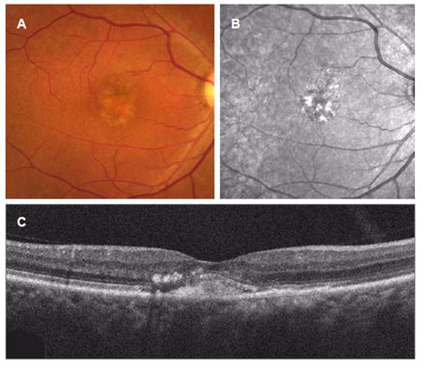 Intraretinal Hyperreflective Foci In Acquired Vitelliform Lesions Download Scientific Diagram