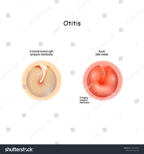 Tympanic Membrane Otitis Media Otitis Media Pediatric Clinics