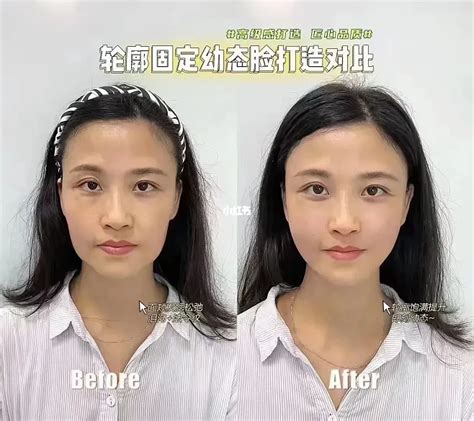 幼态脸打造案例分享 术前下垂 松垮显老 术后轮廓饱满提升 即刻幼态
