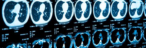 Basic Exploration And Visualization Of Lung Ct Scans With Python By José Henrique Medium