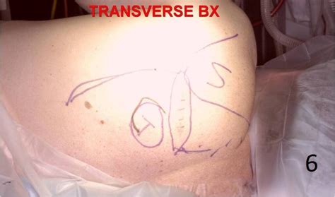 Pleomorphic Liposarcoma Tumor Surgery Network