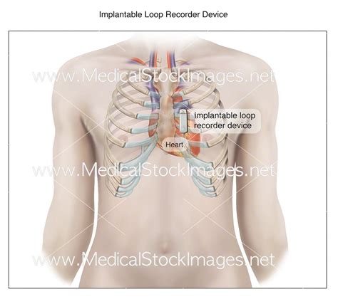 Implantable Loop Recorder Device For The Heart Medical Stock Images