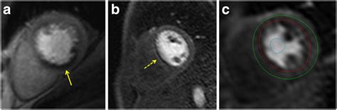 Perfusion Imaging A Perfusion Defect In The Inferior Segments Yellow Download Scientific