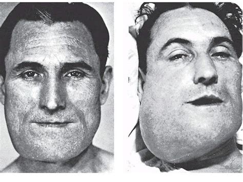 Osteosarcoma Medizzy