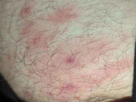 Cellulitis R Medical Advice