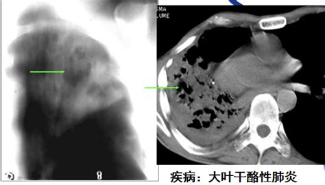 胸部常见CT十大征象的诊断及应用二 MedSci cn