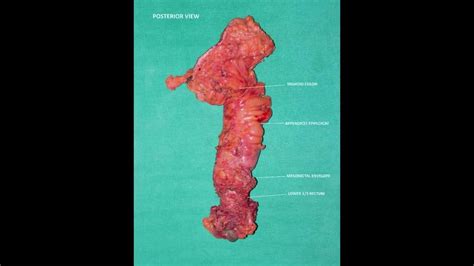 Abdomino Perineal Excision Of Rectum Laparoscopysurgery Youtube
