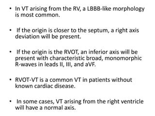 QRS Axis Change During Ventricualr Tachycardia VT PPT