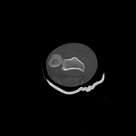Radiopaedia Case Trans Scaphoid Perilunate Fracture Dislocation Id