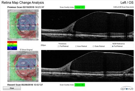 Vmt Oct Retina Image Bank