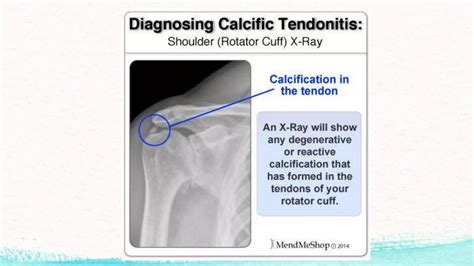 Calcific Tendinitis Of The Rotator Cuff Pptx