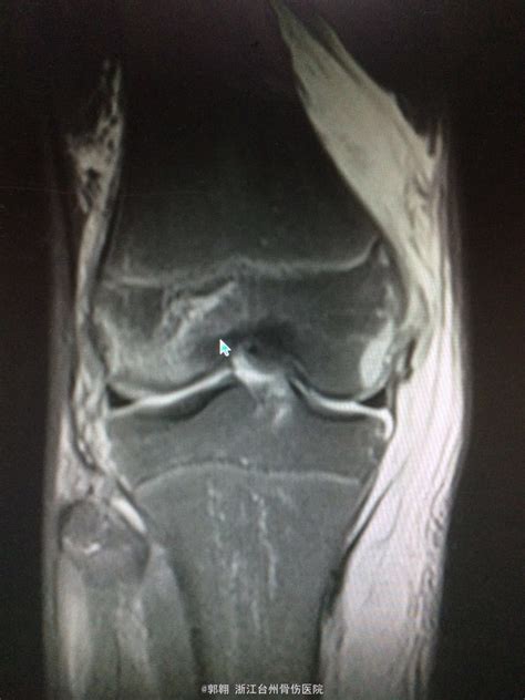 少年膝关节韧带损伤病例