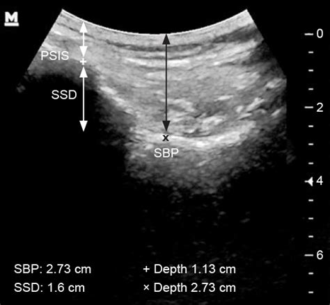Sacral Sulcus Landmark