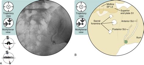 Sacroiliac Intraarticular Joint Injection—posterior Approach Inferior