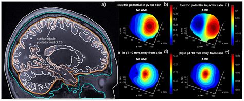 Improving Eeg Forward Modeling Using High Resolution Five Layer Bem Fmm