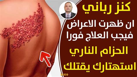 علاج الحزام الناري بطريقة طبيةأعراض الحزام الناريأسباب الحزام الناري