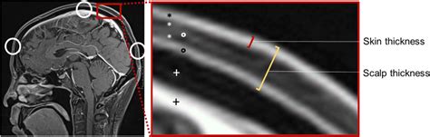 Skin Thickening Of The Scalp And High Signal Intensity Of De Investigative Radiology