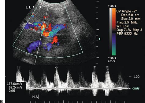 Ultrasound Evaluation Of The Portal And Hepatic Veins Thoracic Key