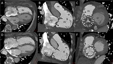 Cardiac Computed Tomography In A Case Of Hypoattenuated Leaflet