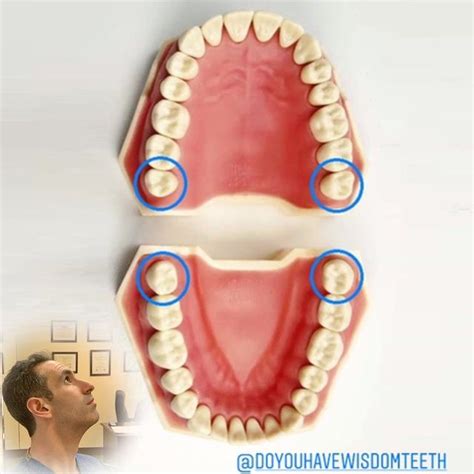 The Wisdom Teeth Story Soms Blog Schiffman Oral Surgery