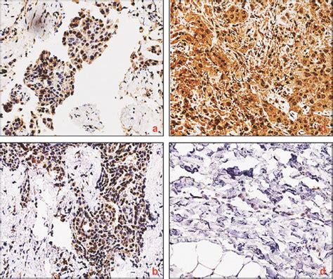 Profiling Of Galectin 9 Tissue Expression In Mm Tumors A C