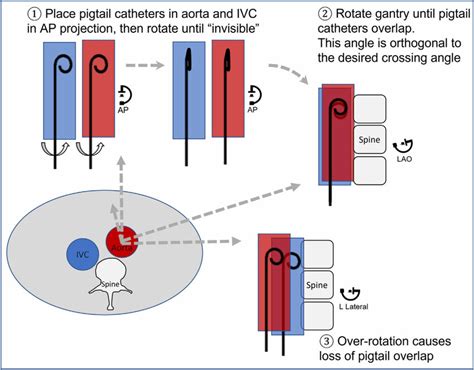 Finding Emergency Transcaval Access Projection Angles Without Ct