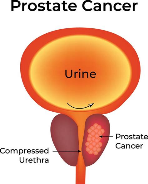 Biochemical Relapse In Prostate Cancer Understanding Psa Recurrence
