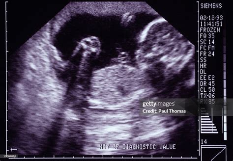20 Weeks Fetal Ultrasound Case Of The Week 576