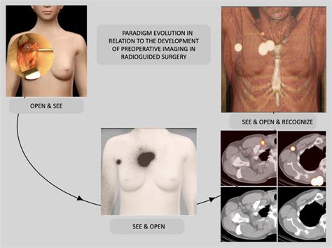 Conceptual Evolution Of The Role Of Preoperative Sentinel Node Mapping Download Scientific
