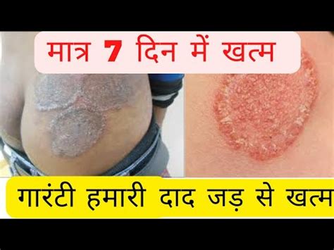 Fungal Infection Treatment Fungal Infection In Private Part Fungaldisease Fungal YouTube