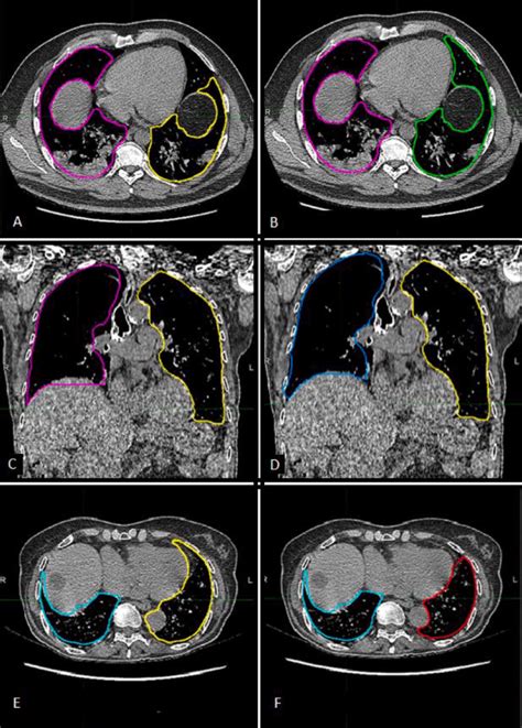 A Automatic Contour Anterior Segments Of Lower Lobes Are Often Not Download Scientific