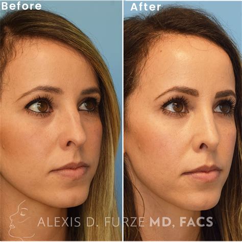 Gallery Alexis D Furze Md Facs