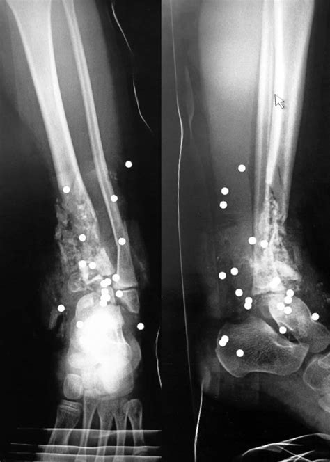 Gustilo Classification The Foot And Ankle Online Journal