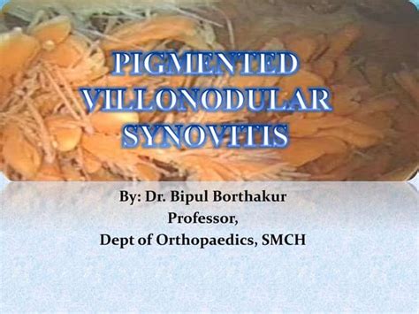 Pigmented Villonodular Synovitis Pptx