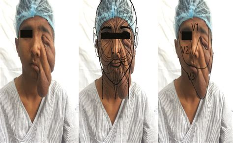 Pigmentation In Plexiform Neurofibroma Following Blaschkos Lines A New Observation Jcas