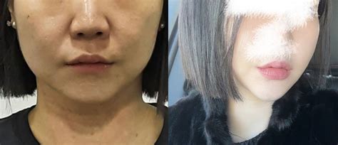 얼굴지방흡입 실리프팅 여덟달 성공 후기입니다 닥터정 리반의원