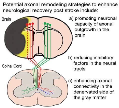 A Diagram Showing Corticospinal Tract Cst Axonal Degeneration And