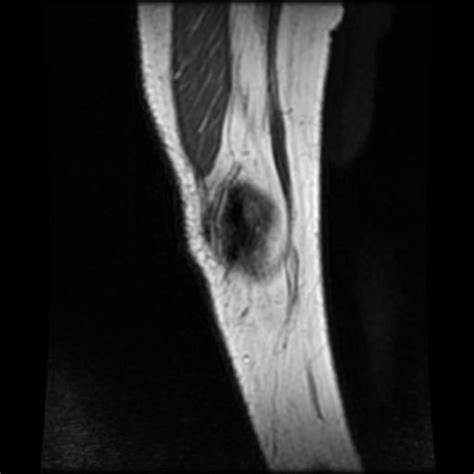 Bone Infarcts Radiopaedia 87453 103788 Sagittal T2 Nc Commons