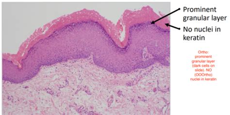 Epithelial Pathologies 1 And 2 Flashcards Quizlet