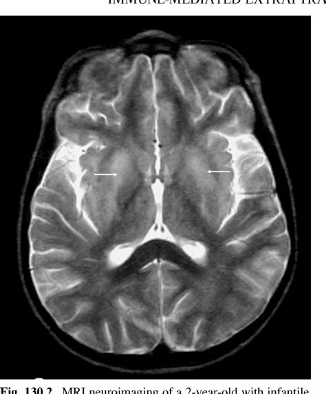 Table 130 1 From Immune Mediated Extrapyramidal Movement Disorders Including Sydenham Chorea