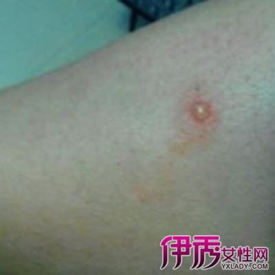 手上脚上起小水泡痒怎么办图手上脚上起小水泡痒怎么办 几个妙招轻松对抗小水泡 2 伊秀健康 yxlady