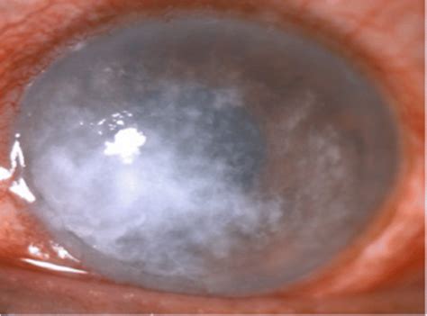 Diffuse Slit Lamp Photograph Showing Para Central Deep Stromal Download Scientific Diagram