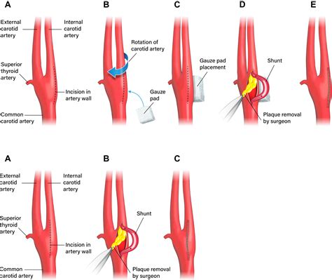 Outcome Of Primary Closure Following Carotid Endarterectomy With A