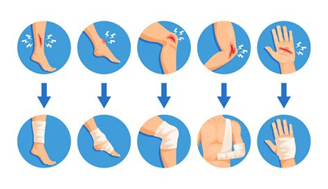 손과 다리 붕대 과정 부상 부위 주위에 붕대를 감습니다 의료용 인포그래픽 1위에 대한 스톡 벡터 아트 및 기타 이미지 1위 개체 그룹 건강 진단 Istock