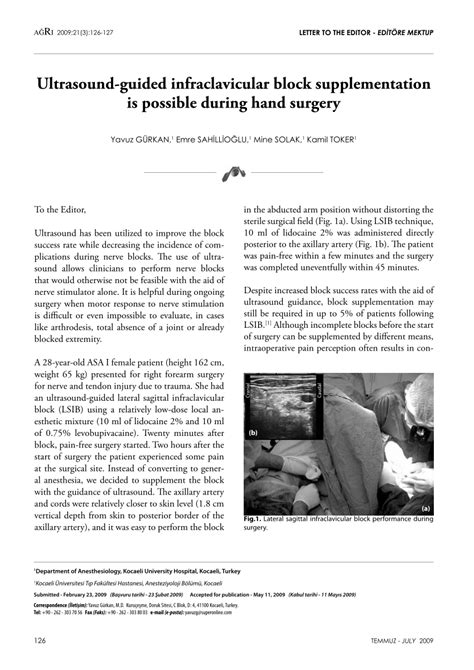 Pdf Ultrasound Guided Infraclavicular Block Supplementation Is Possible During Hand Surgery