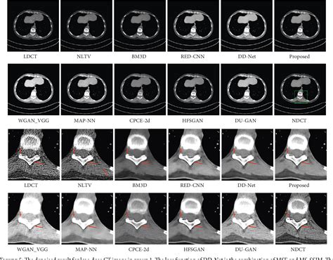 Figure 10 From Low Dose Ct Image Denoising Based On Improved Dd Net And
