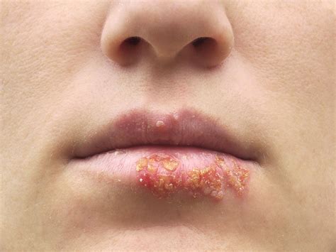 Obat Penyakit Herpes Di Apotik Id