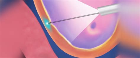 How Long Does Botox Last For Bladder Conditions