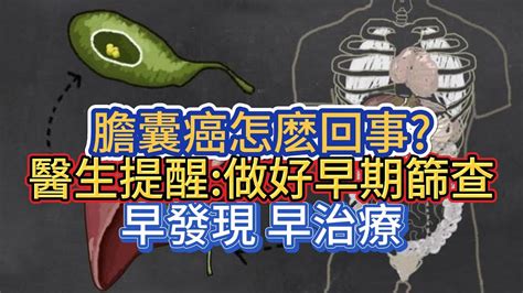 膽囊癌怎麽回事醫生提醒做好早期篩查，早發現，早治療 Youtube